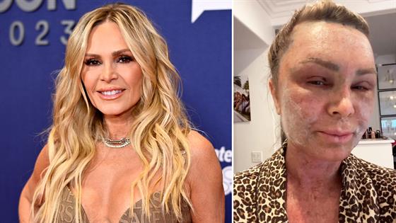 'Real Housewives’ Tamra Judge Looks Unrecognizable Following Cosmetic ...
