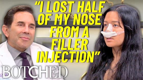 Non-Surgical Nose Job Nightmare: Melissa Lose Half Her Nose | Botched | E!